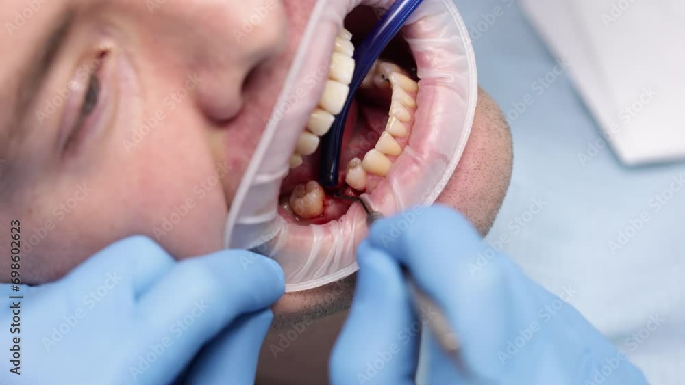 Preparation gums before installing a healing abutment, often referred to as a healing cap or ...