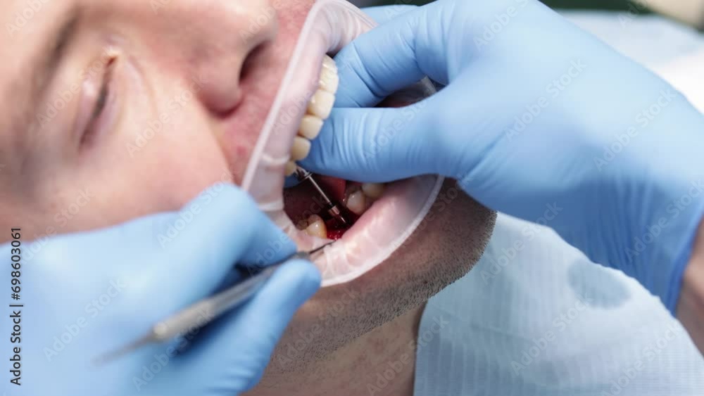 Installing a healing abutment, often referred to as a healing cap or ...