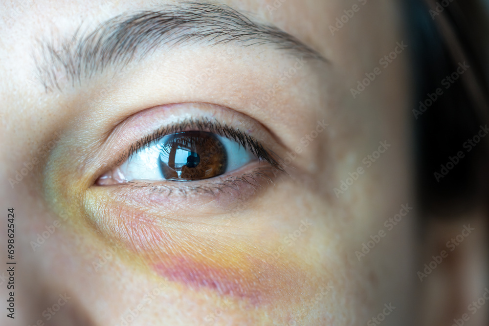 Close-up eye bruise hematoma of young woman suffered from domestic ...