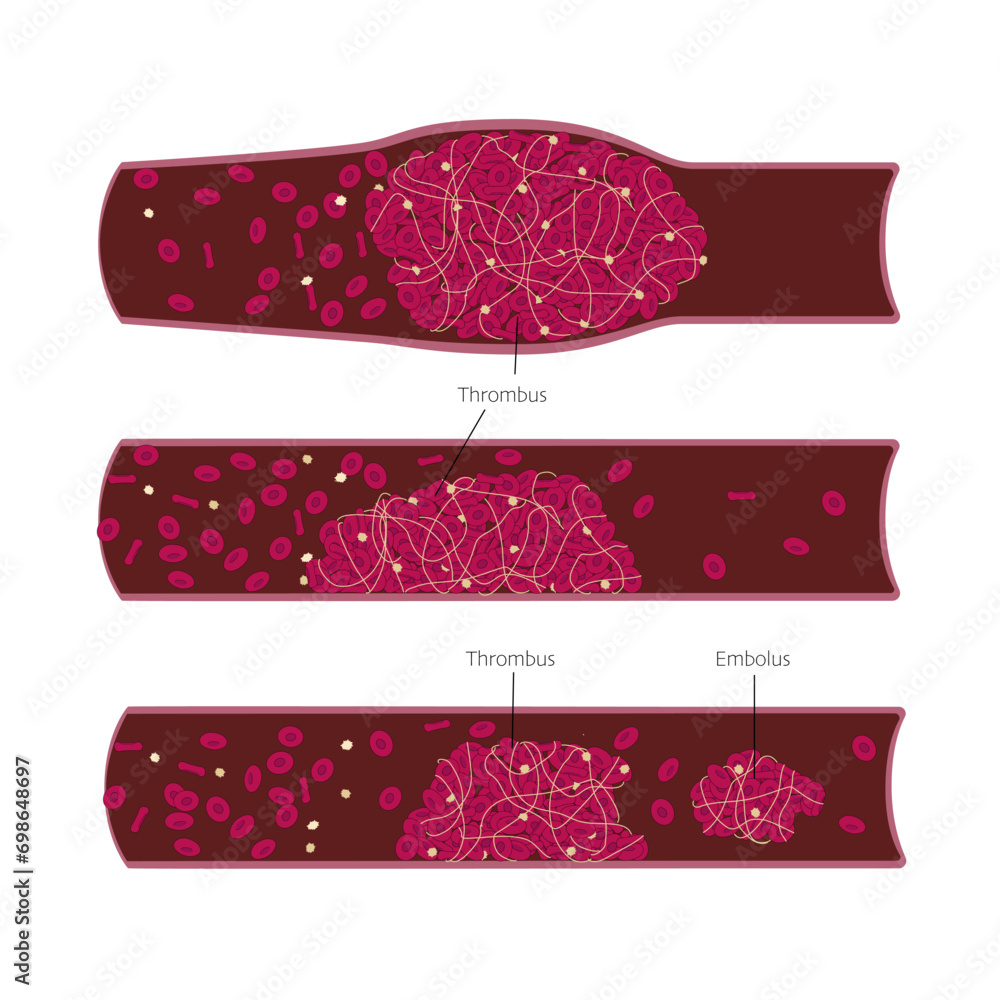 Vetor de Different types of thrombus and embolus in the blood vessels ...