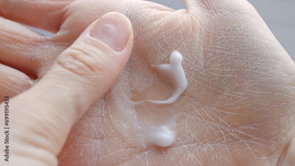 Using hand cream for dry skin close-up moisturizing palms and treating ...