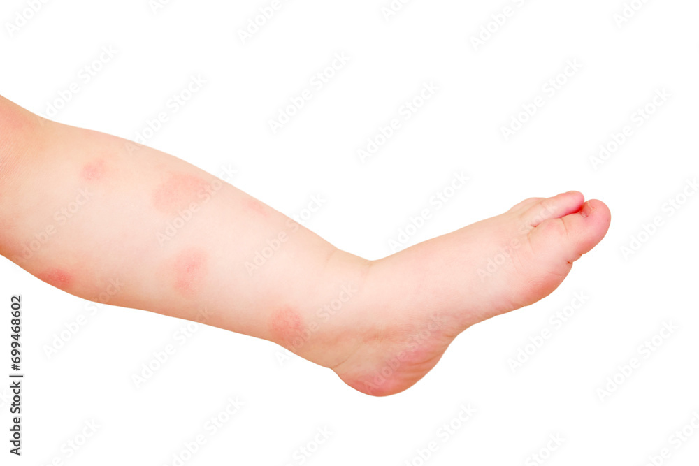 Toddler baby skin care, allergies and dermatitis, isolated on white ...