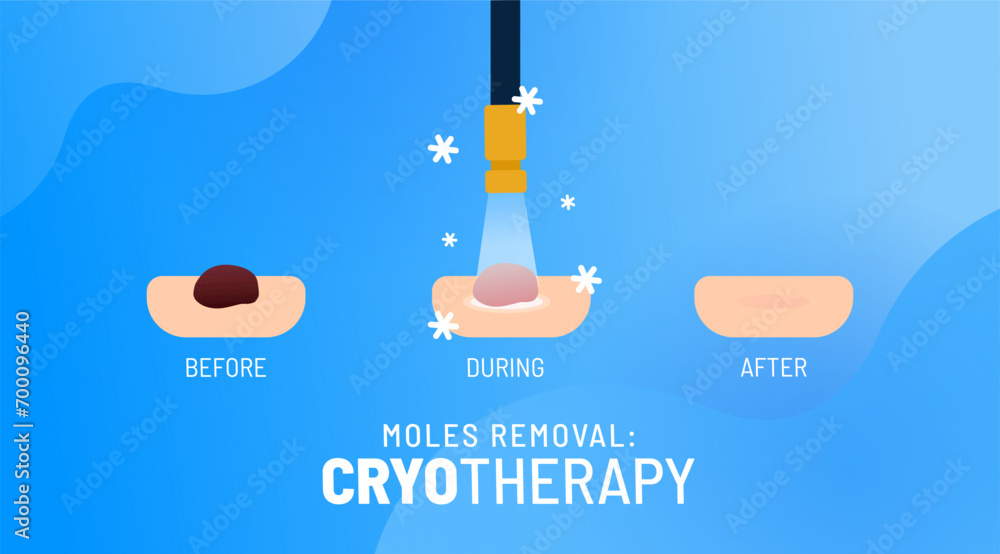 Cryotherapy process vector illustration. Removing mole, wart, tumor ...
