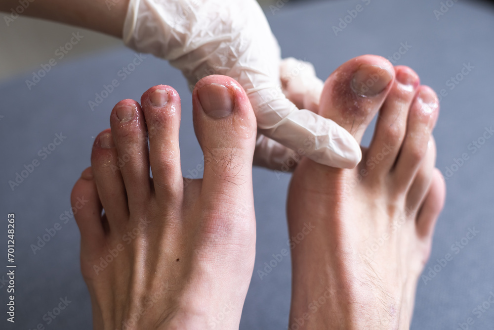 A white man holding his toes, showing what looks like a rash with red ...