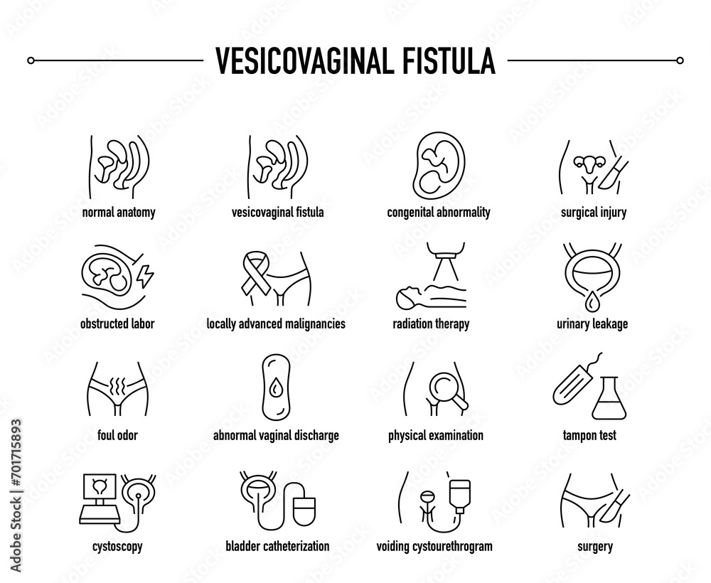 Vesicovaginal Fistula symptoms, diagnostic and treatment vector icons ...