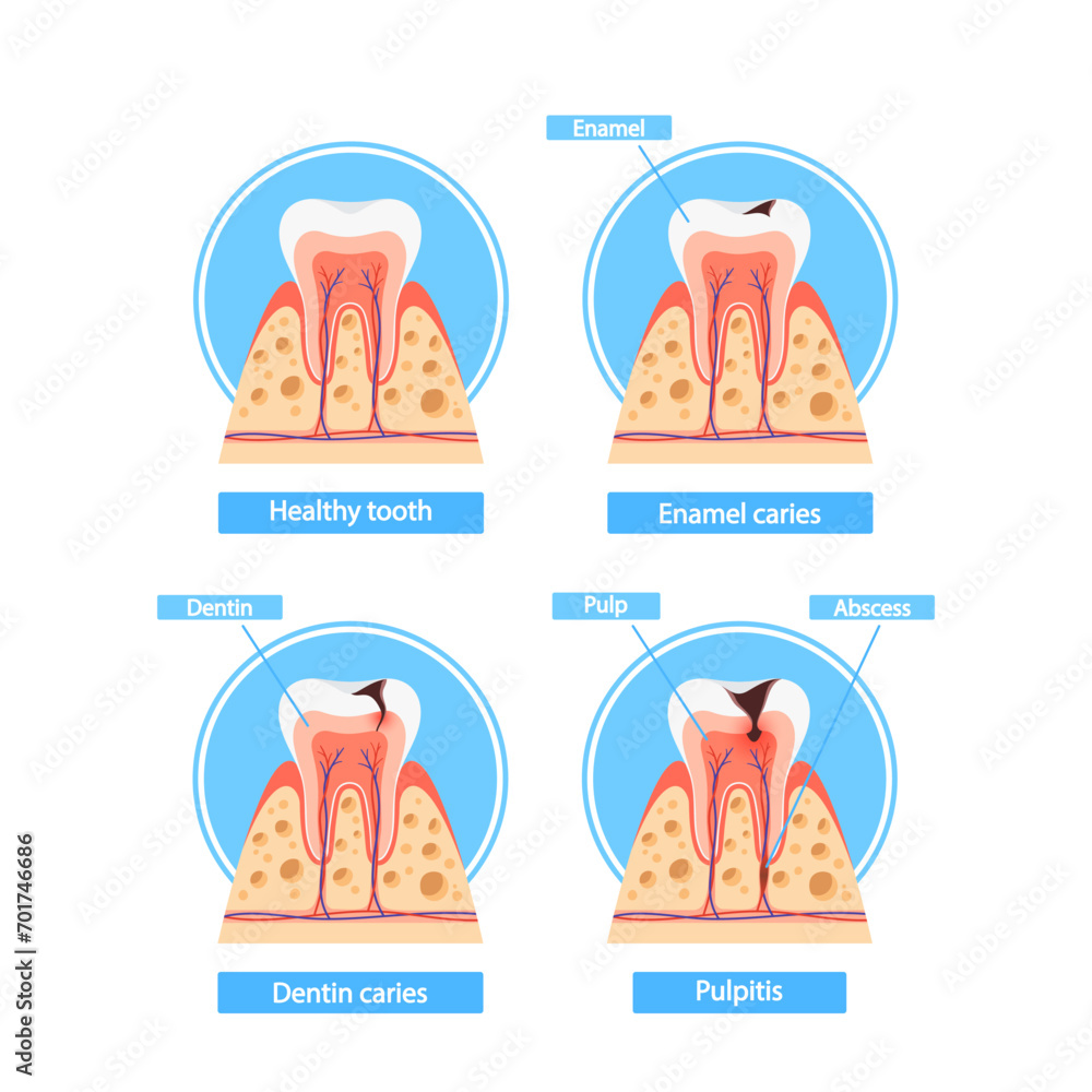 Caries Stages Infographics. Healthy Tooth, Enamel Caries, Dentin Caries ...