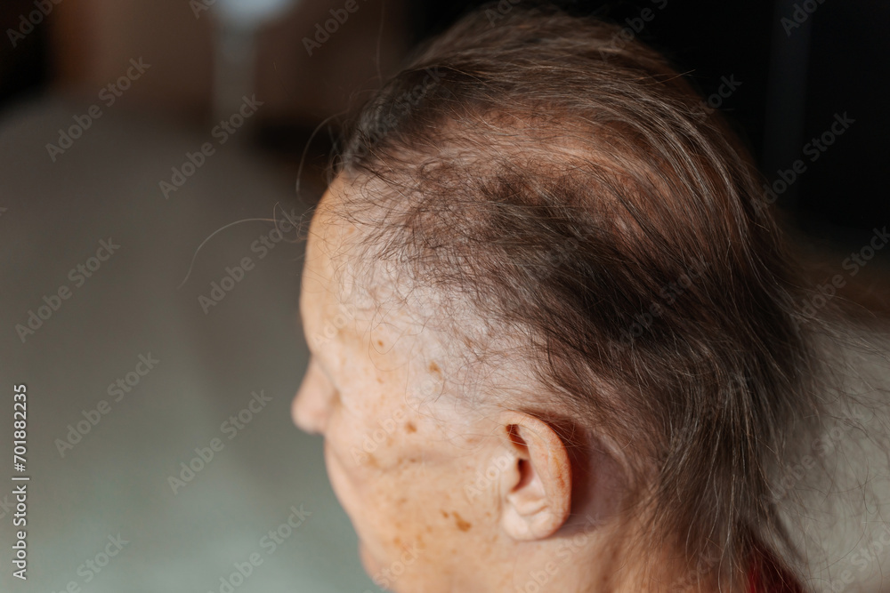 fallen hair from a woman's head due to a cancerous tumor. balding ...
