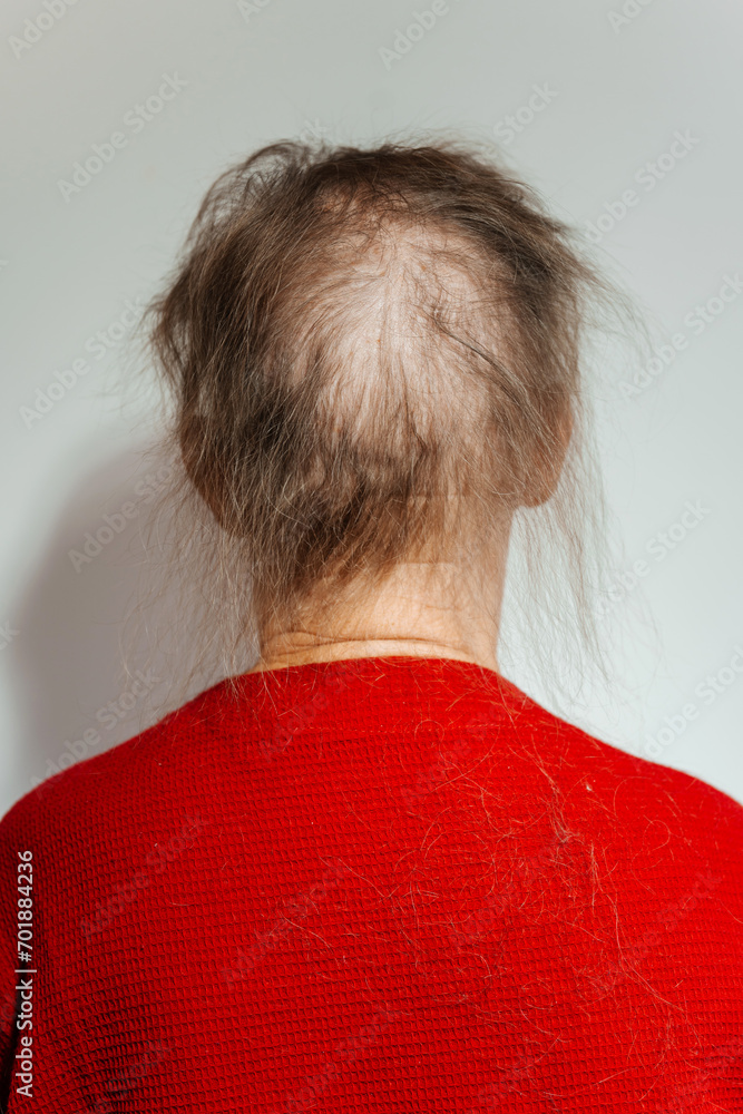 fallen hair from a woman's head due to a cancerous tumor. balding ...