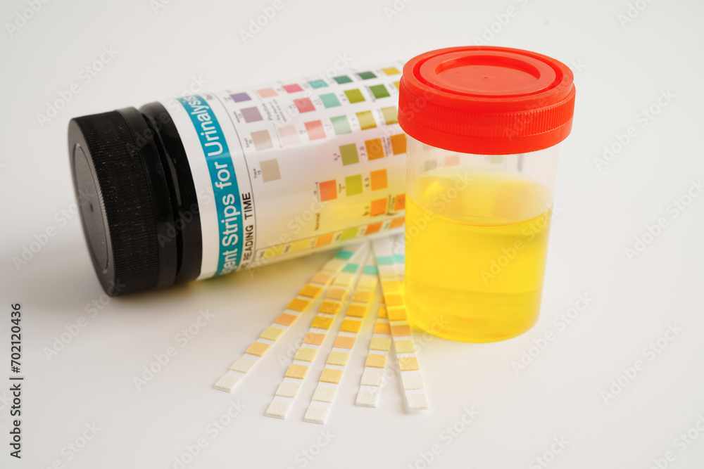 Urinalysis, urine cup with reagent strip pH paper test and comparison ...