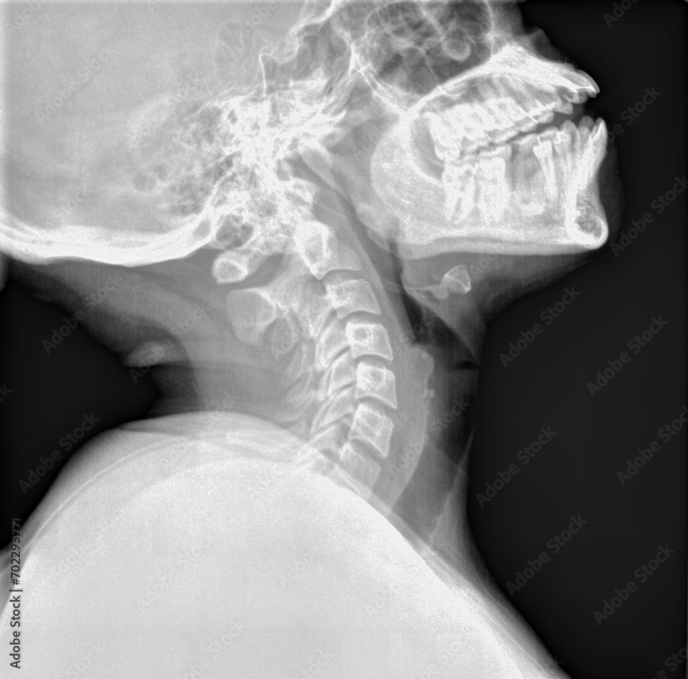 Normal film xray or radiograph of a cervical neck. Lateral extension ...