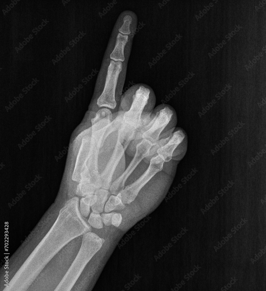 Film xray x-ray or radiograph of a hand and fingers showing the number ...