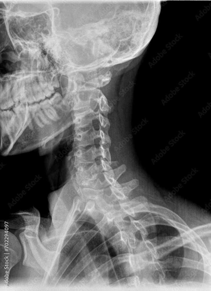 Normal film xray or radiograph of a cervical neck. Lateral slightly ...