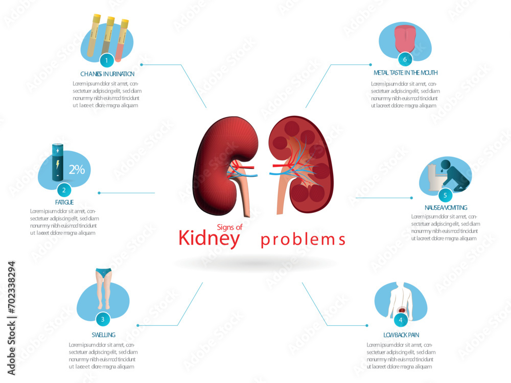Vecteur Stock Infographic about the main signs that indicate kidney ...