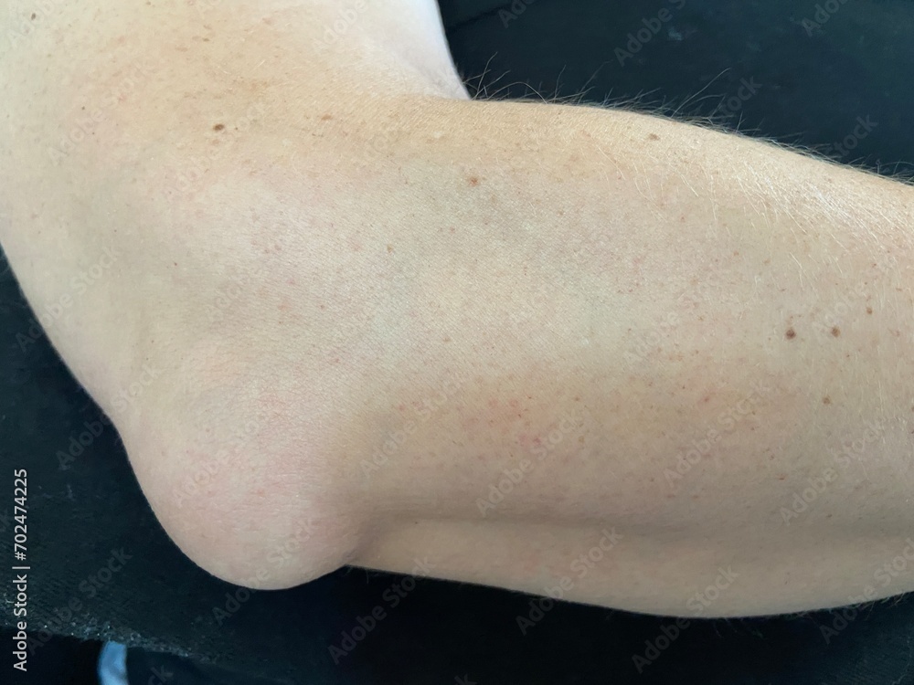 olecranon bursitis is sometimes called “Popeye’s elbow.” Bursitis is a swelling of the bursitis ...