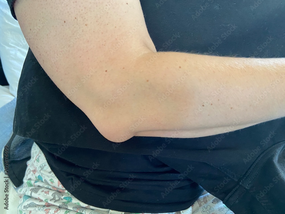 olecranon bursitis is sometimes called “Popeye’s elbow.” Bursitis is a swelling of the bursitis ...