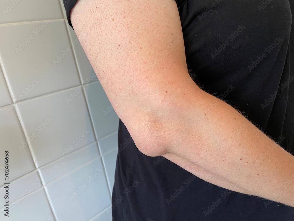 olecranon bursitis is sometimes called “Popeye’s elbow.” Bursitis is a ...
