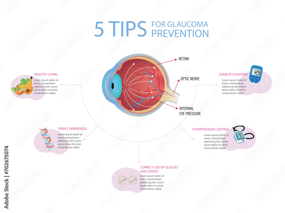 5 tips for glaucoma prevention. Diagram of an eye with glaucoma on ...