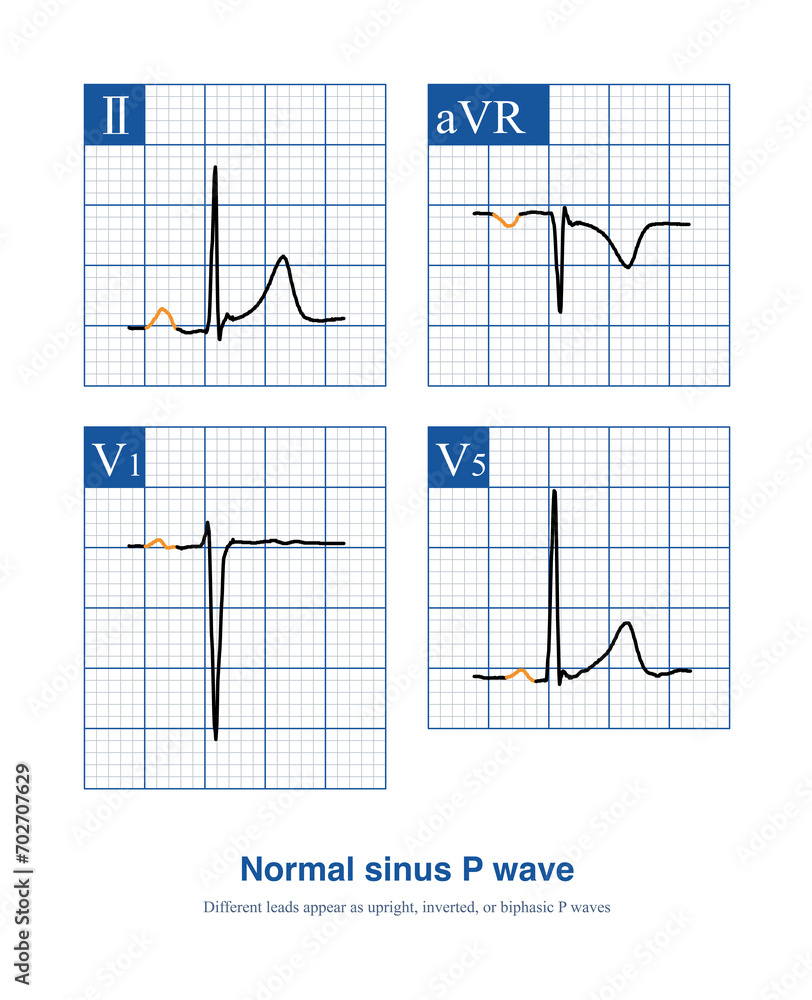 Normal sinus P waves, which may appear as upright, inverted, or ...