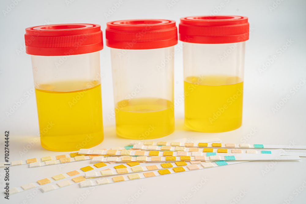 Urinalysis, urine cup with reagent strip pH paper test and comparison ...