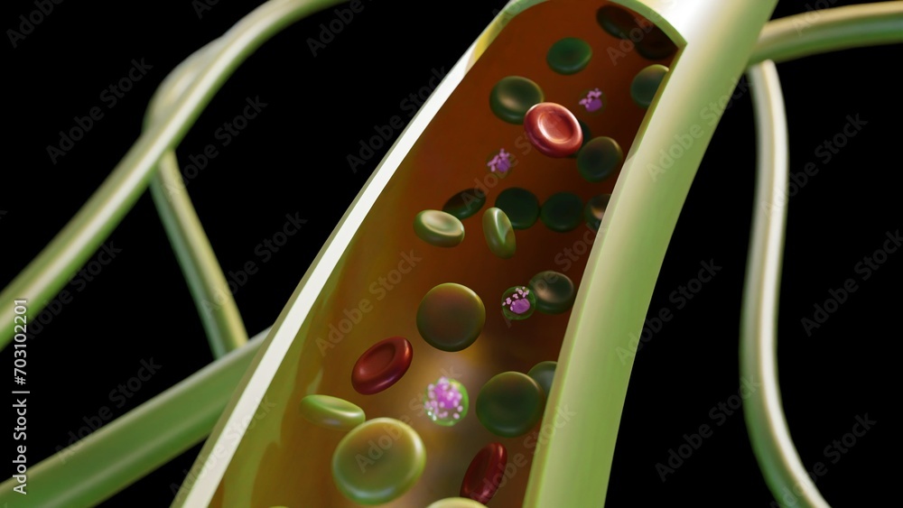 Sulfhemoglobinemia, a condition characterized by abnormally high levels ...