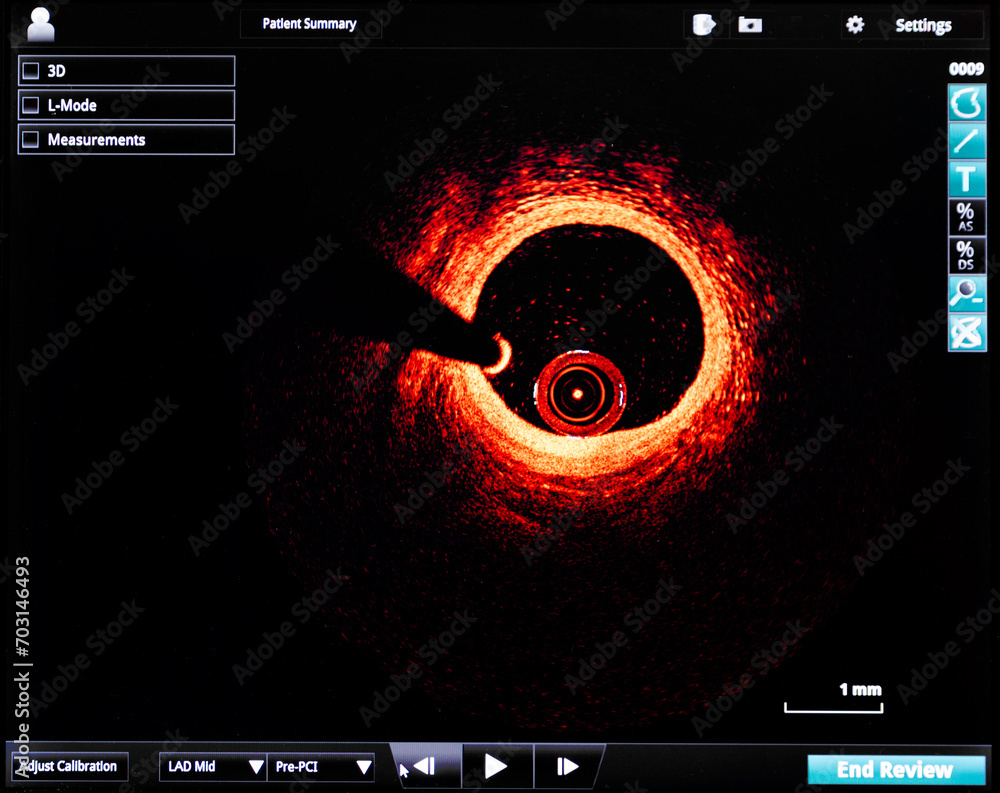 intravascular optical coherence tomography oct image angiography ...