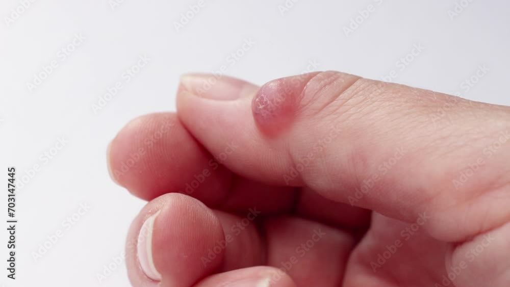 Ganglion cyst (synovial cyst disease) on the thumb of a woman’s hand ...