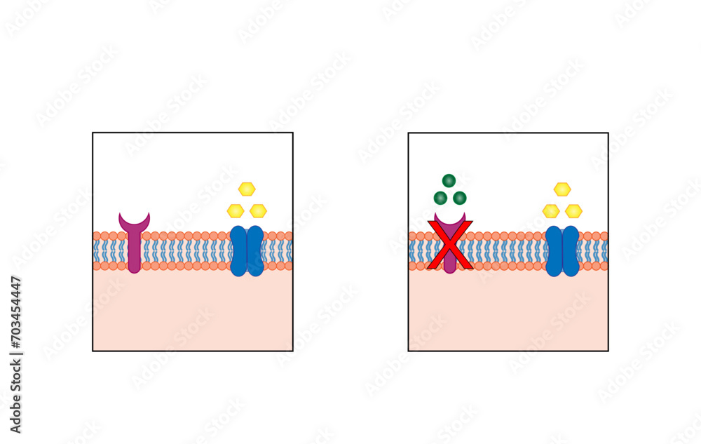 Diabetes mellitus type 1, pancreas's failure to produce enough insulin ...