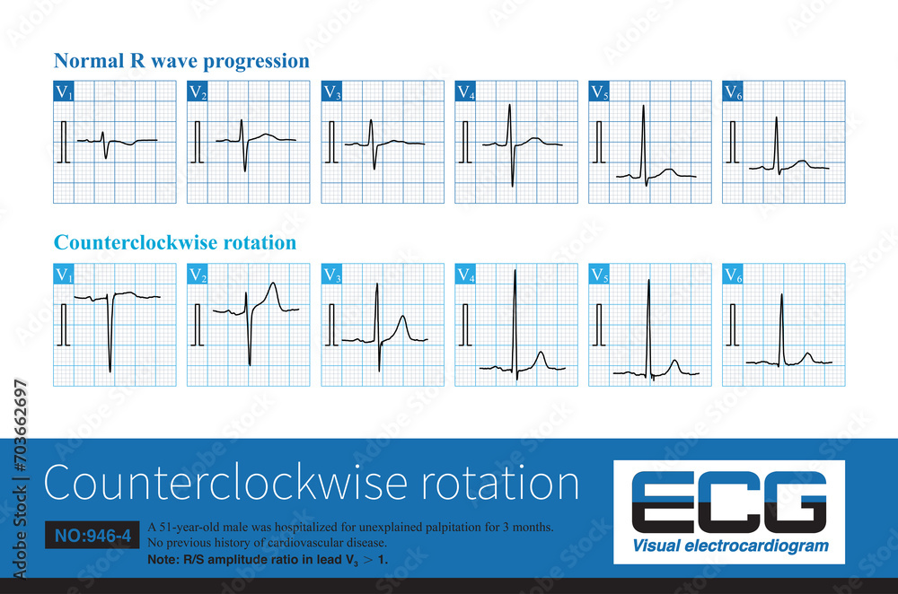 Generally, in chest leads, the R/S amplitude ratio =1 appears in lead V3-V4. Once it appears in ...
