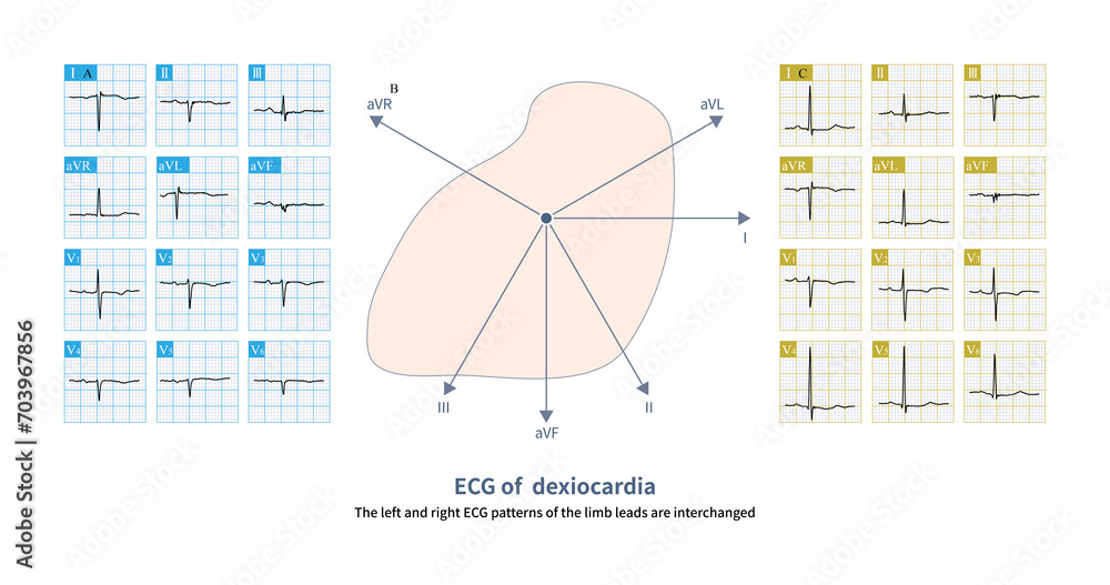 The characteristic of a dexiocardia ECG is that in the limb lead, the ...