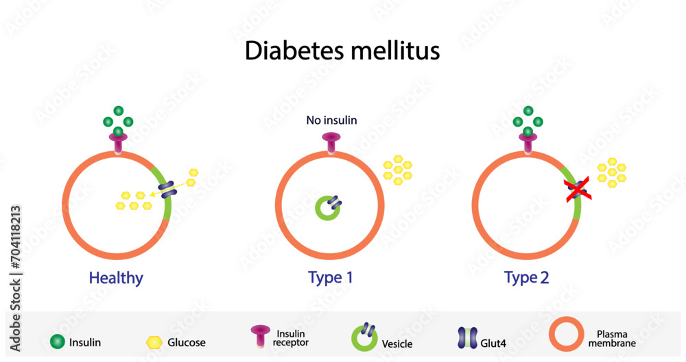 Diabetes mellitus type 1, pancreas's failure to produce enough insulin ...