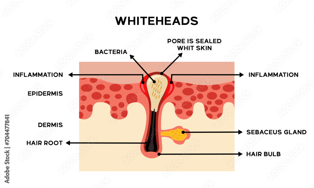Illustration of the anatomy of whitehead skin along with an explanation of the names of each ...