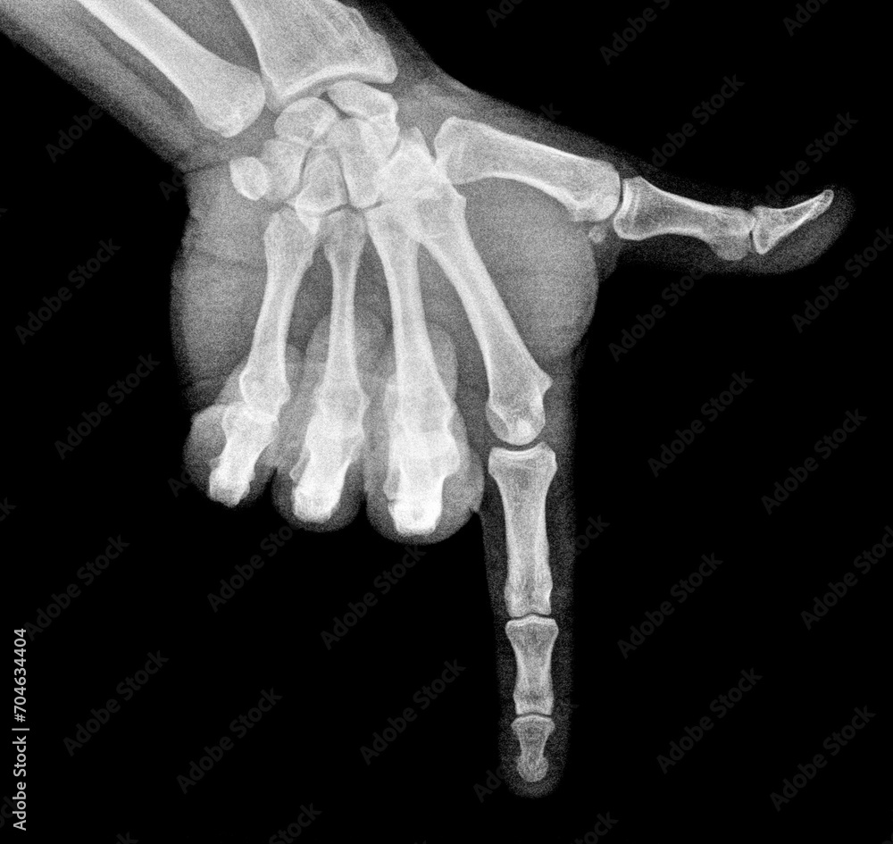 Film xray x-ray or radiograph of a thumb and finger in gestural ...