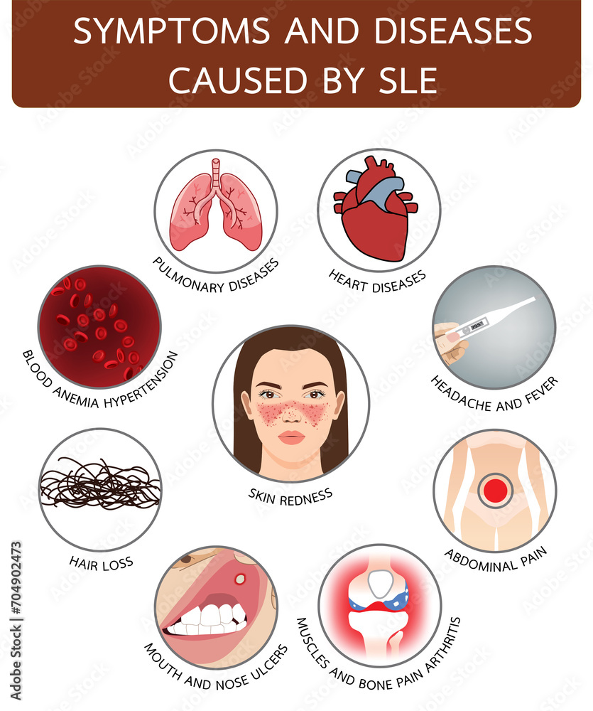Symptoms and diseases caused by SLE, infographic illustration on white background Stock ...