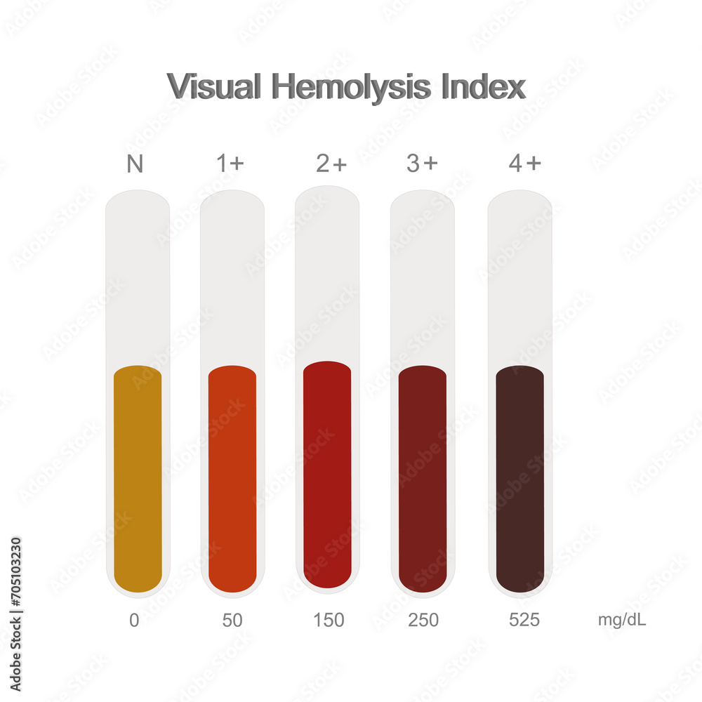 The Hemolysis Visual index were interpreted in the level of Normal or ...
