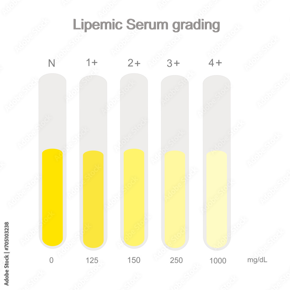 The Lipemic serum grading were interpreted in the level of Normal or ...