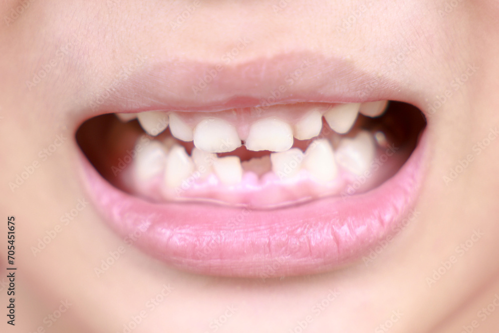 Child milk teeth fall out from gum. little boy permanent tooth grows in ...