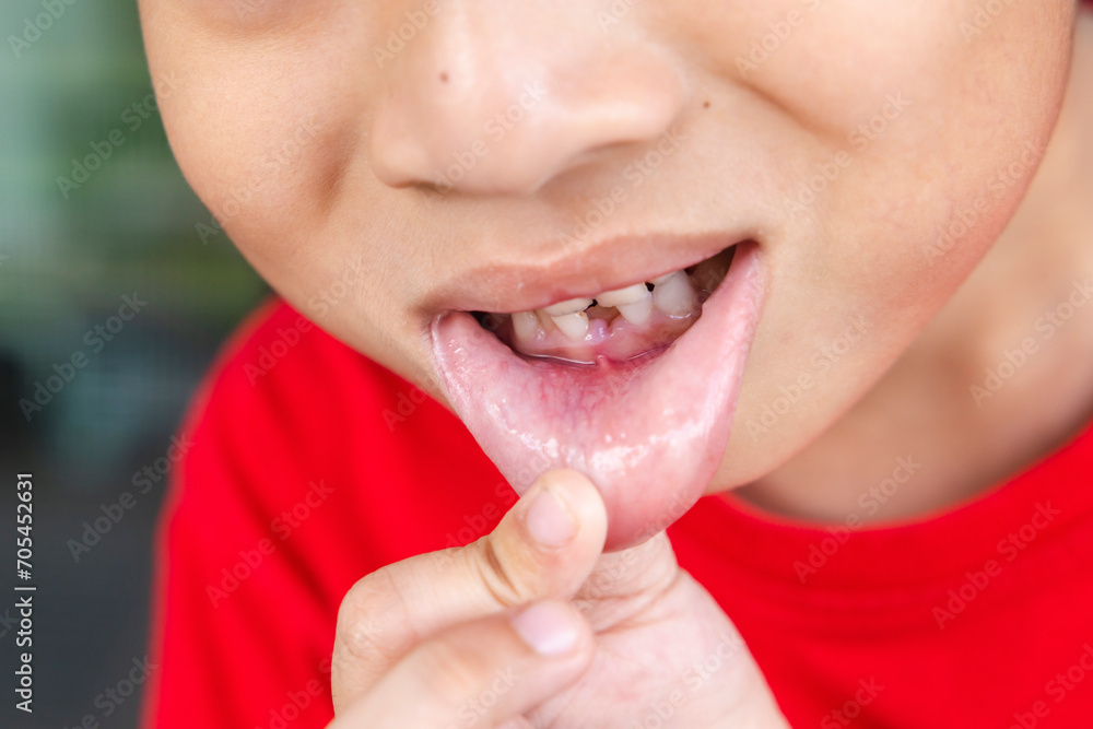 Child milk teeth fall out from gum. little boy permanent tooth grows in ...