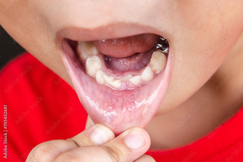 Child milk teeth fall out from gum. little boy permanent tooth grows in ...