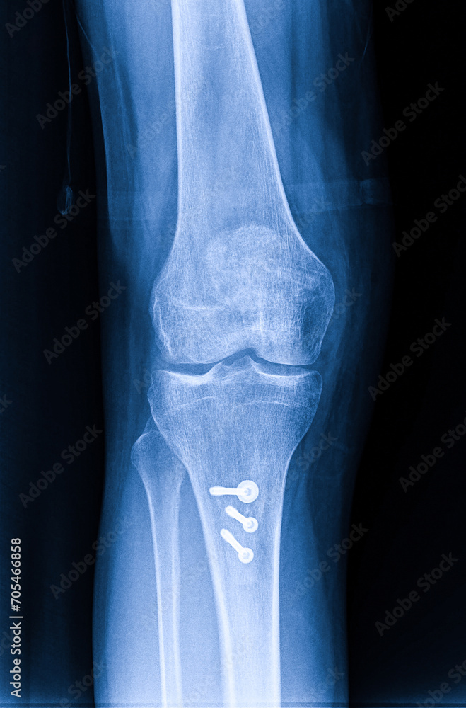 X Ray Knee Joint Fracture Proximal Tibia And Post Fix Fracture Proximal