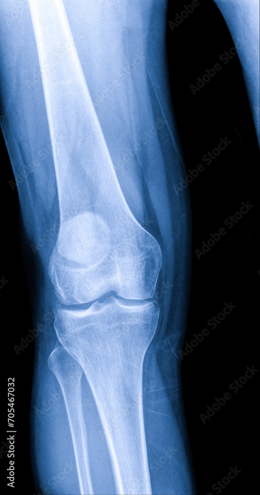 Foto de Knee joint x-ray (AP and LATERAL) view fracture and ...