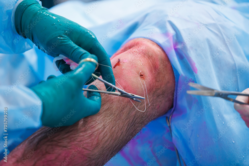 Surgeon use laparoscopic instrument for leg patient minimally invasive ...