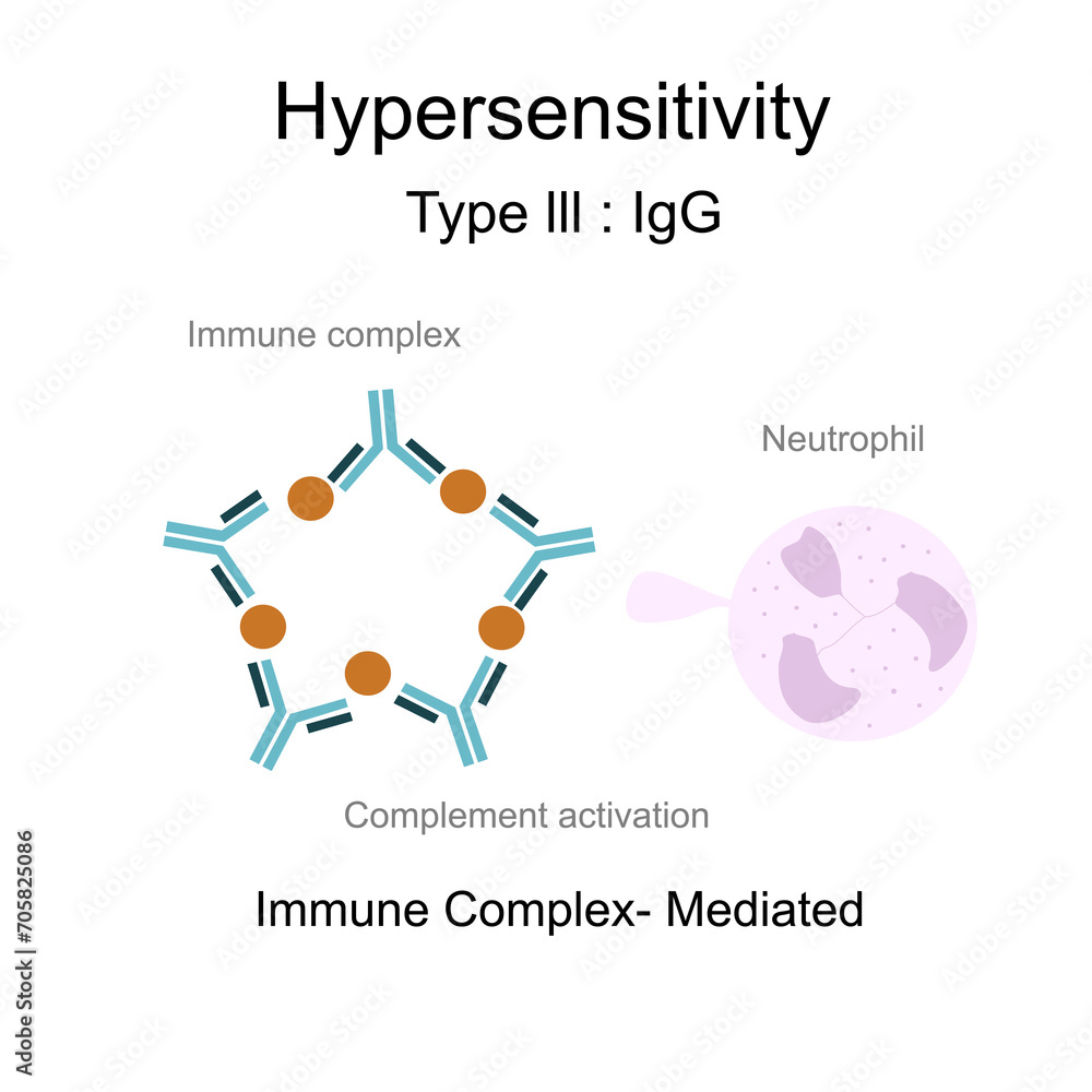 Poster The diagram of Hypersensitivity type lll : Immune complex -Mediated that shows the Immune ...