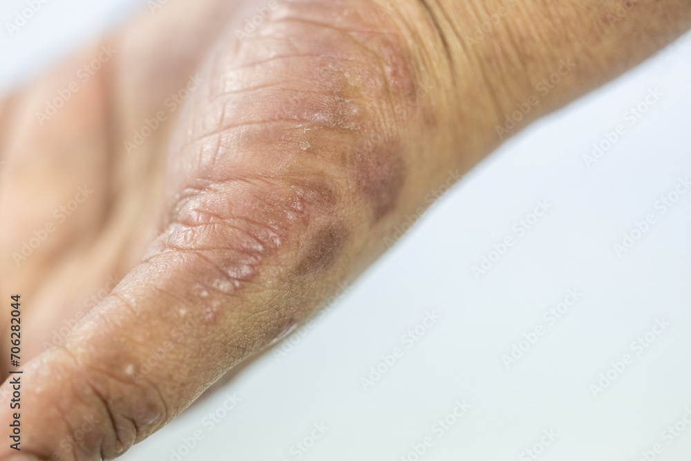 Atopic dermatitis (AD), also known as atopic eczema, is a type of ...