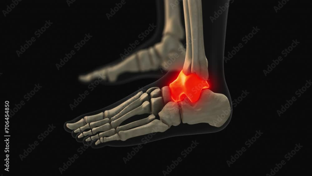 Medical animation of the talus bone pain Stock Video | Adobe Stock