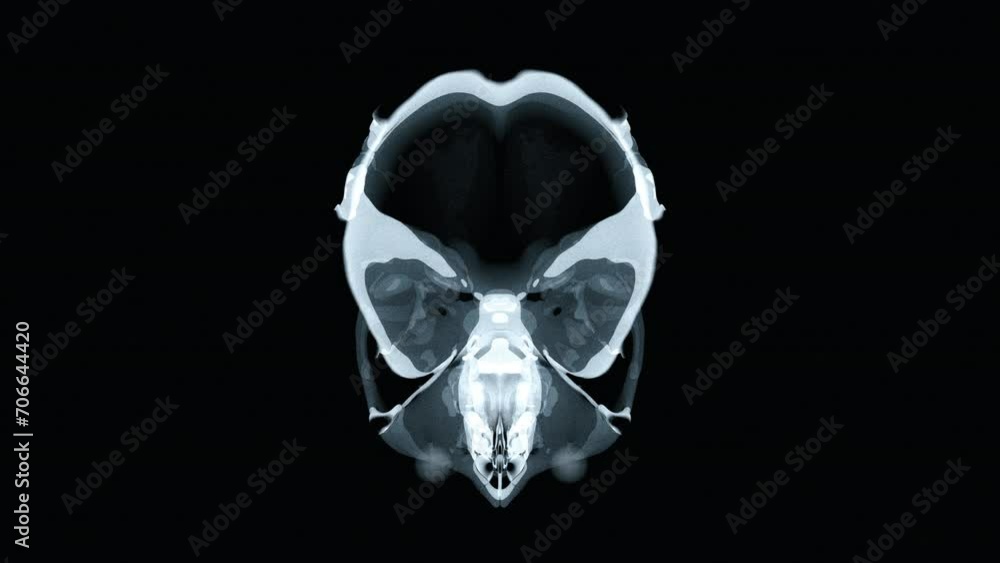 Head CT Scan Animation. Rendering of a computed tomography (CT) scan of ...