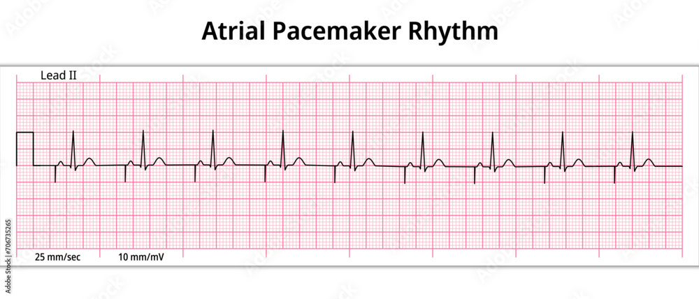 ECG Atrial Pacemaker Rhythm - Single Chamber - 8 Second ECG Paper ...
