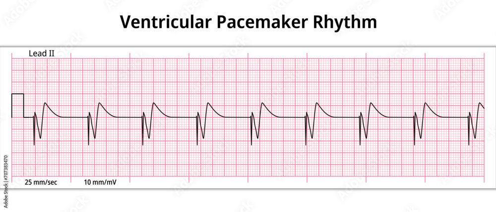 ECG Ventricular Pacemaker Rhythm - Single Chamber - 8 Second ECG Paper ...