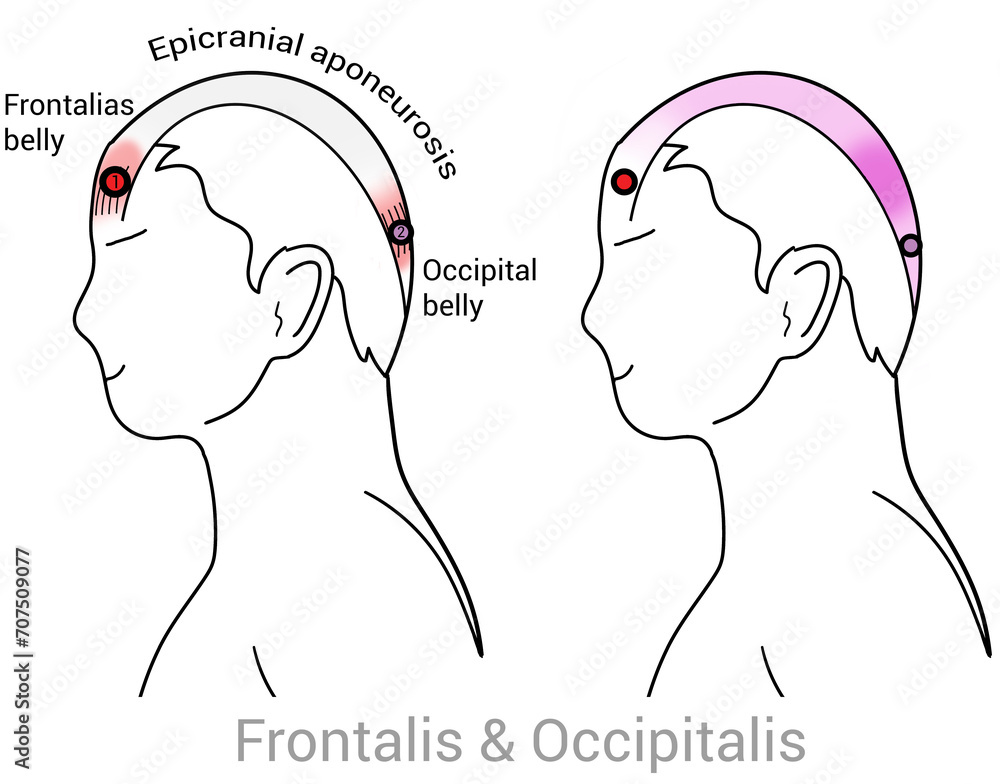 Frontalis & Occipitalis: Myofascial trigger points and associated pain ...