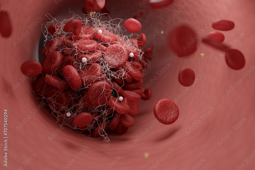 Arterial blockage by blood clot hindering the flow of blood cells ...