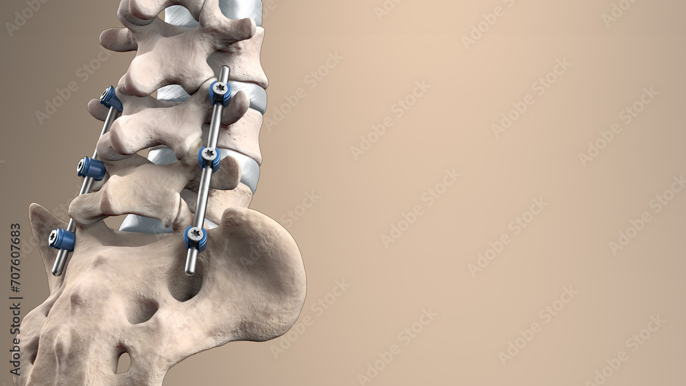 Posterior Lumbar Fusion with Pedicle Screws and Rods Stock Illustration ...